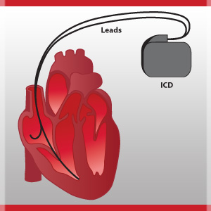 Coping with your partner’s ICD and heart disease – Heart Sisters