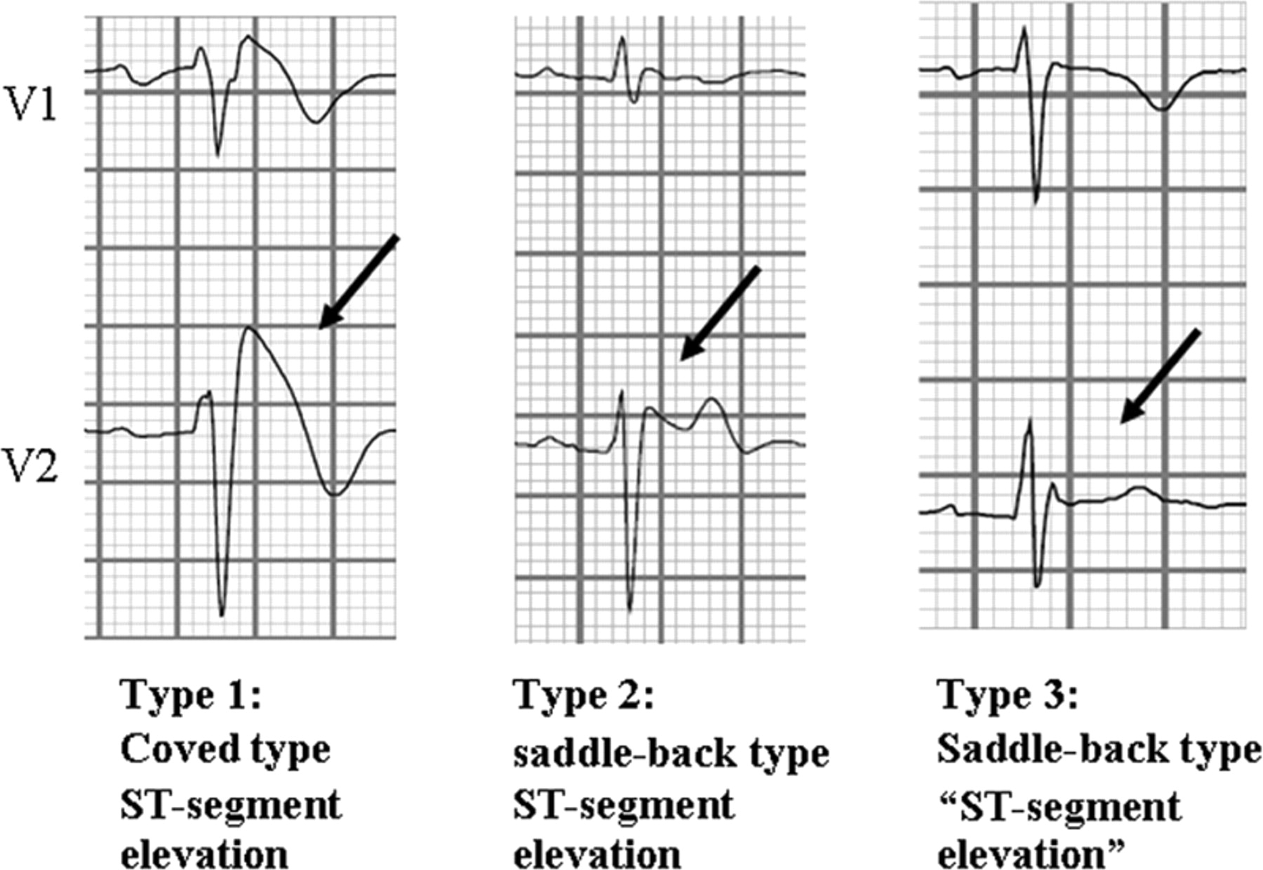 Diagnosed with what? Brugada Syndrome?! – Heart Sisters