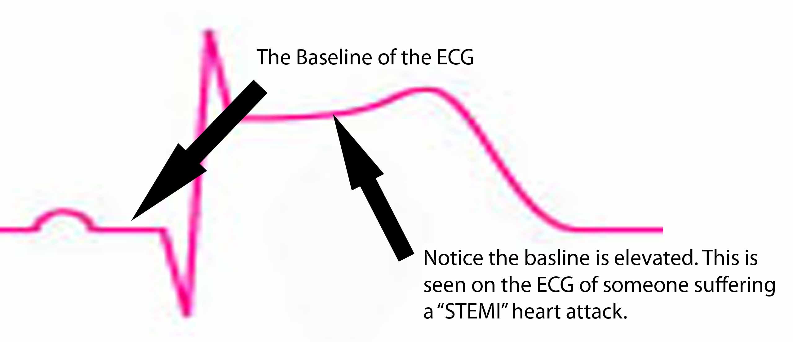 When your “significant EKG changes” are missed – Heart Sisters