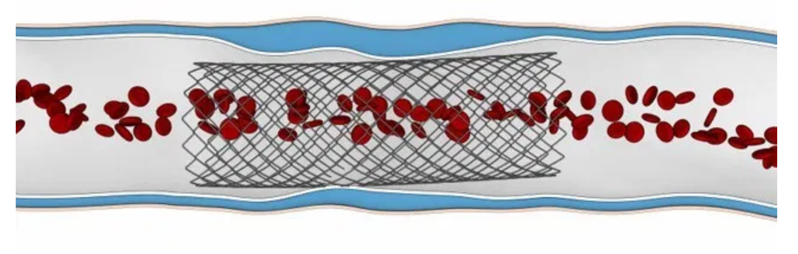 Coronary stents: interventions that come with a cost – Heart Sisters